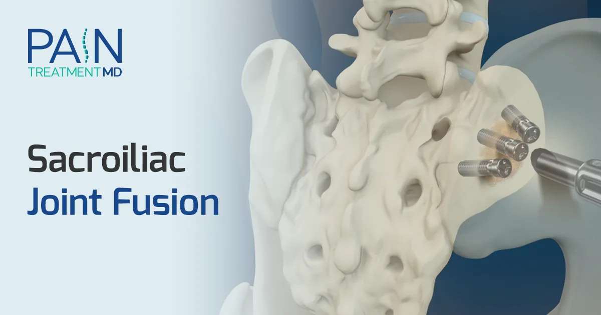 Sacroiliac Joint Fusion SI Joint Fusion: A Case Study Of Why