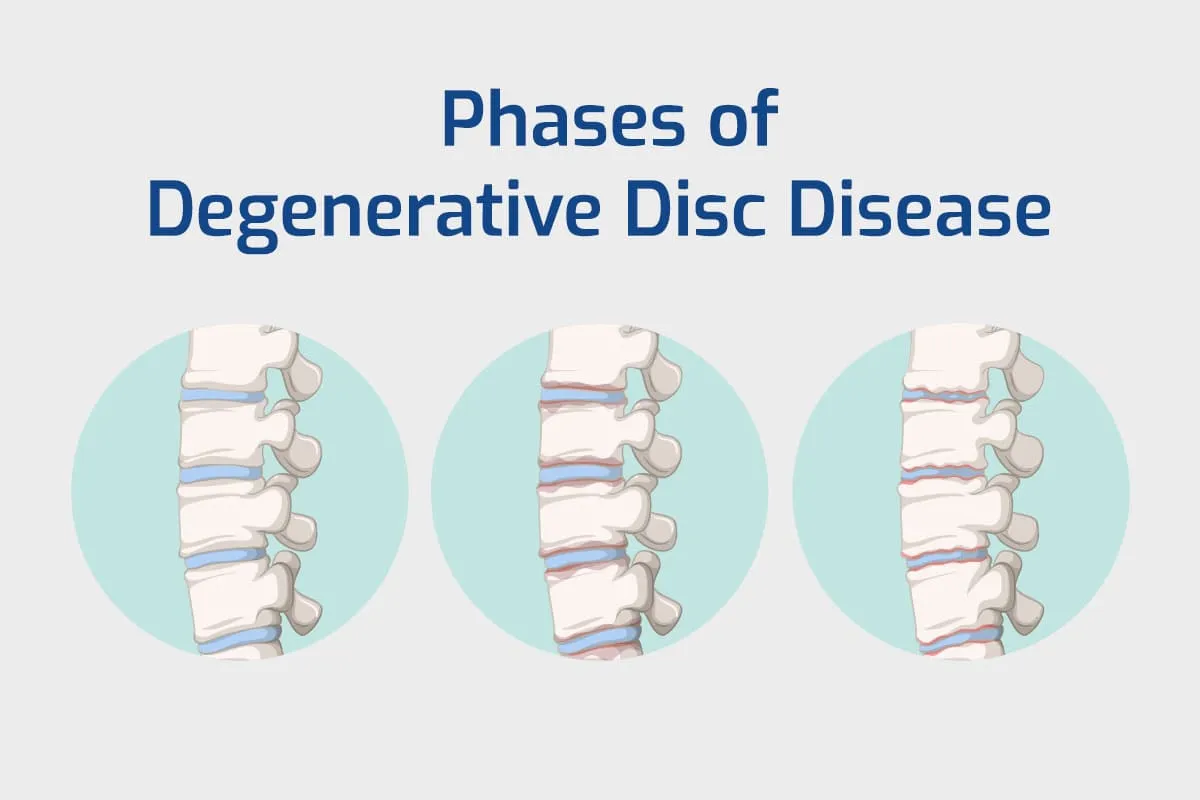 How to Prevent Degenerative Disc Disease?