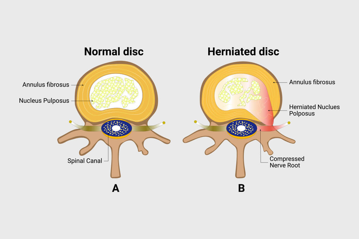 Best Herniated Disc Exercises for Safe Pain Relief